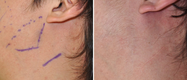 Healing of Neck Incision for Masseter Muscle Dehiscence repair Dr Barry ...