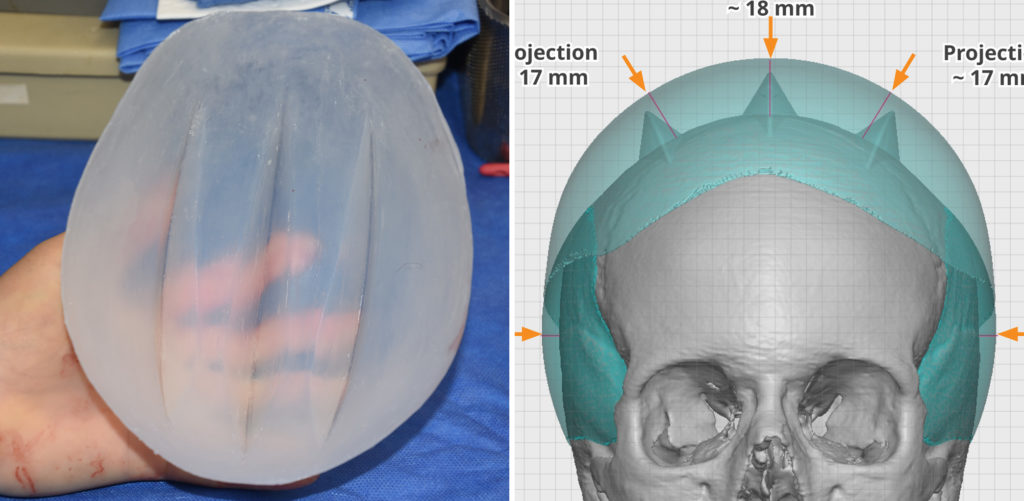 Plastic Surgery Case Study - 3rd Custom Skull Implant for Female Crown ...