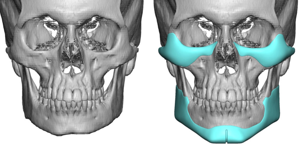 Plastic Surgery Case Study - Male Facial Masculinization Surgery with ...