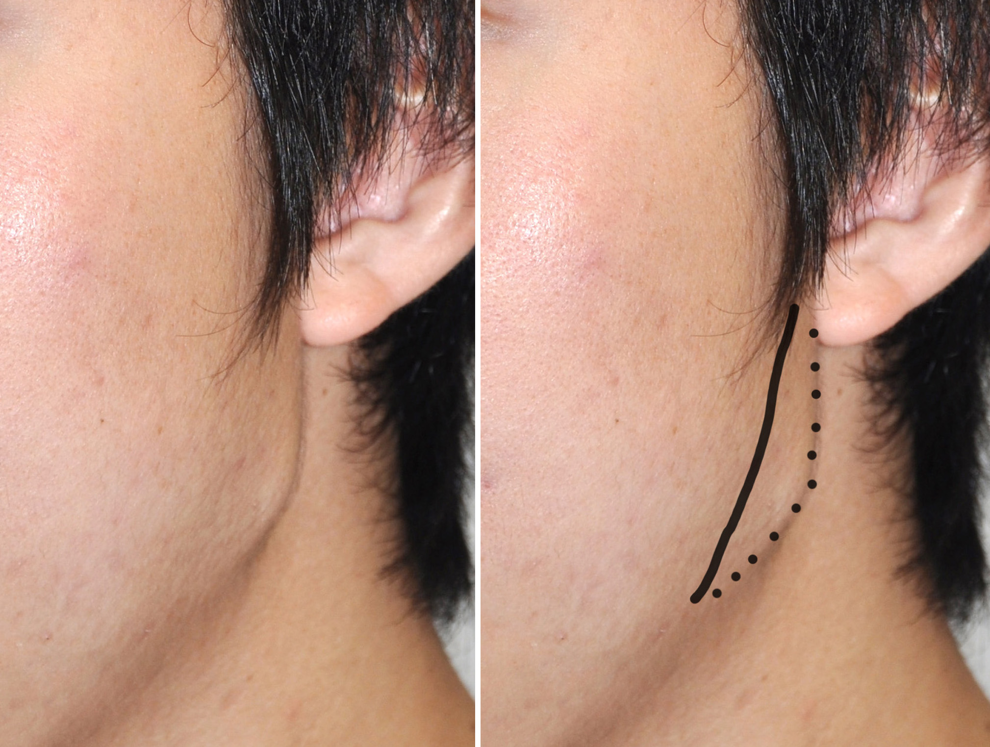 Plastic Surgery Case Study - Direct Repair of Masseter Muscle ...