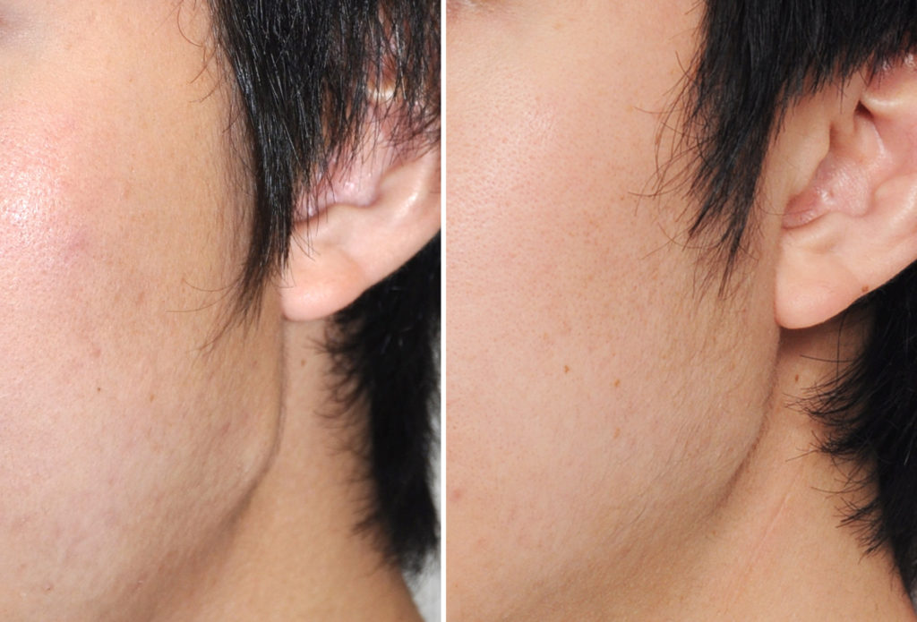 Plastic Surgery Case Study - Direct Repair of Masseter Muscle ...