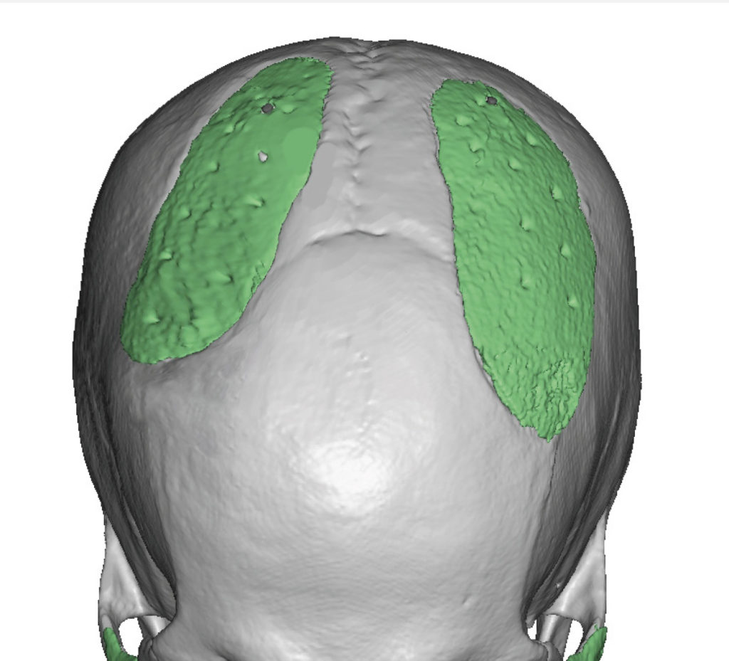 Plastic Surgery Case Study - Custom Parasagittal Skull Implants for ...