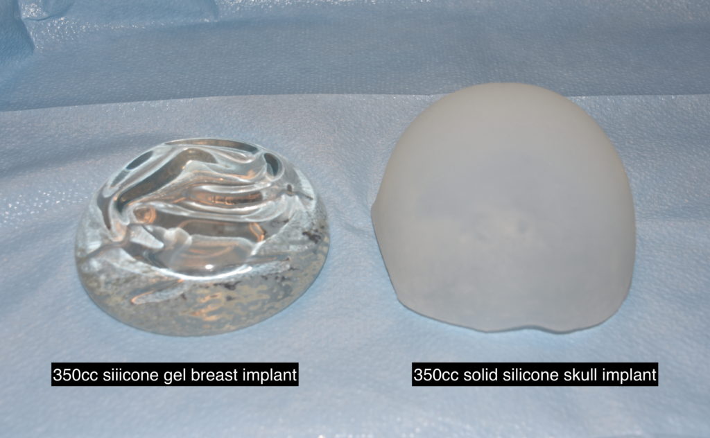 Silicone Skull Implants vs Silicone Breast Implants Dr Barry Eppley ...