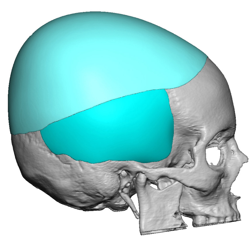 Plastic Surgery Case Study - Total Temporal Implant Augmentations ...