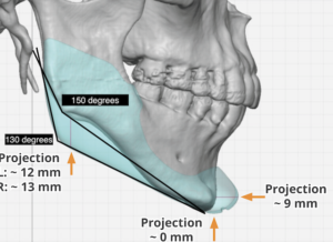 Change in Gonial Angle with Vertical Jaw Angle Lengthening Dr Barry ...