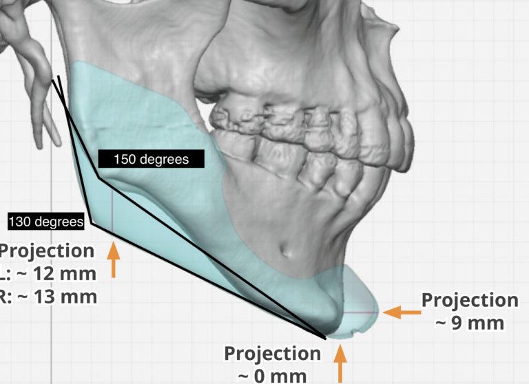 Change in Gonial Angle with Vertical Jaw Angle Lengthening Dr Barry ...