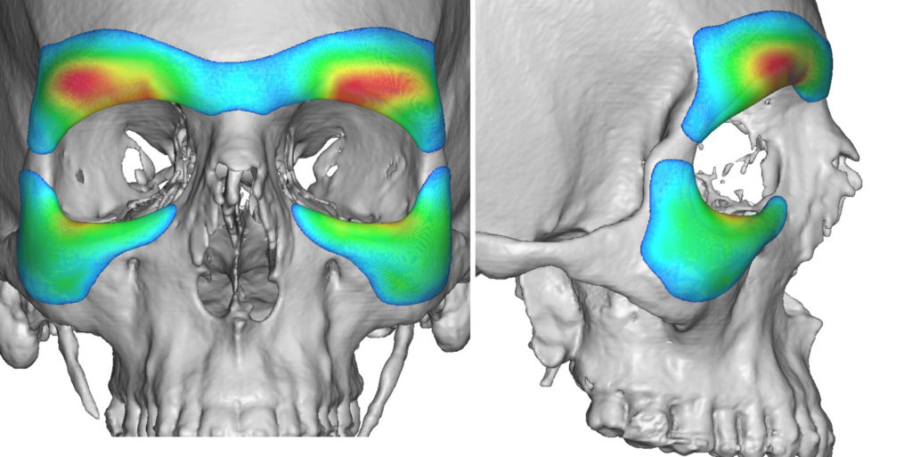 Plastic Surgery Case Study - Combined Custom Brow Bone and Infraorbital ...