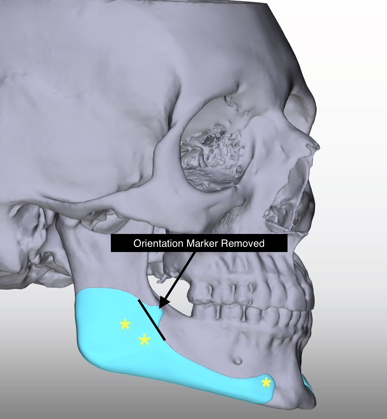 Plastic Surgery Case Study - Custom Jaw Angle Implants for Correction ...