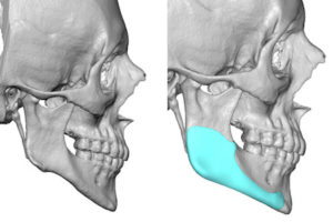 Plastic Surgery Case Study - Custom Jaw Angle Implants for Correction ...