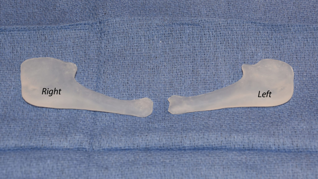 Plastic Surgery Case Study - Custom Jaw Angle Implants for Correction ...