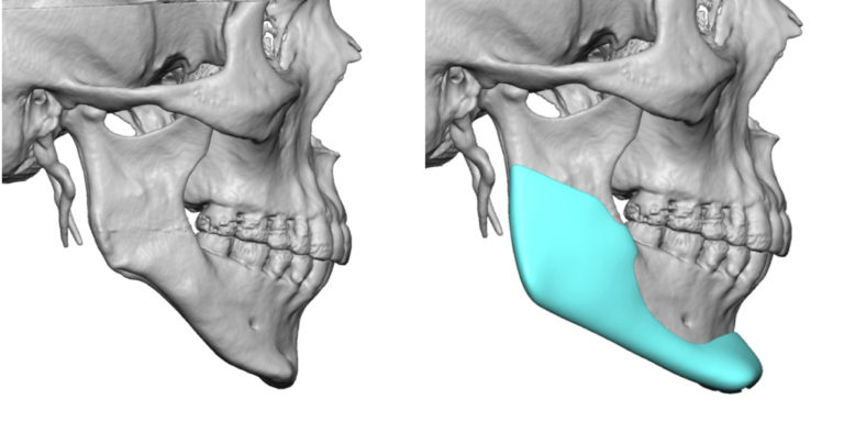 Plastic Surgery Case Study - Custom Jawline Implant Design for the High ...