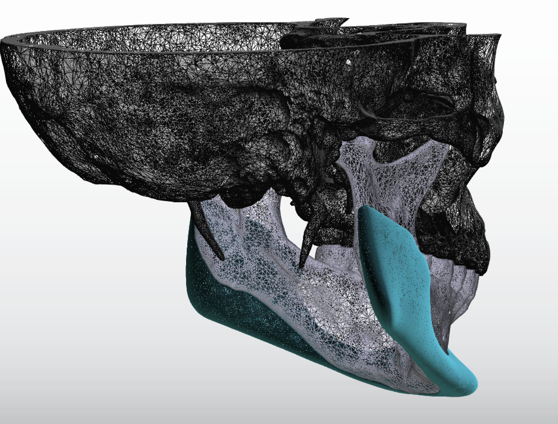 The Use Of Mandibular Plane and Gonial Angle Measurements in Custom ...