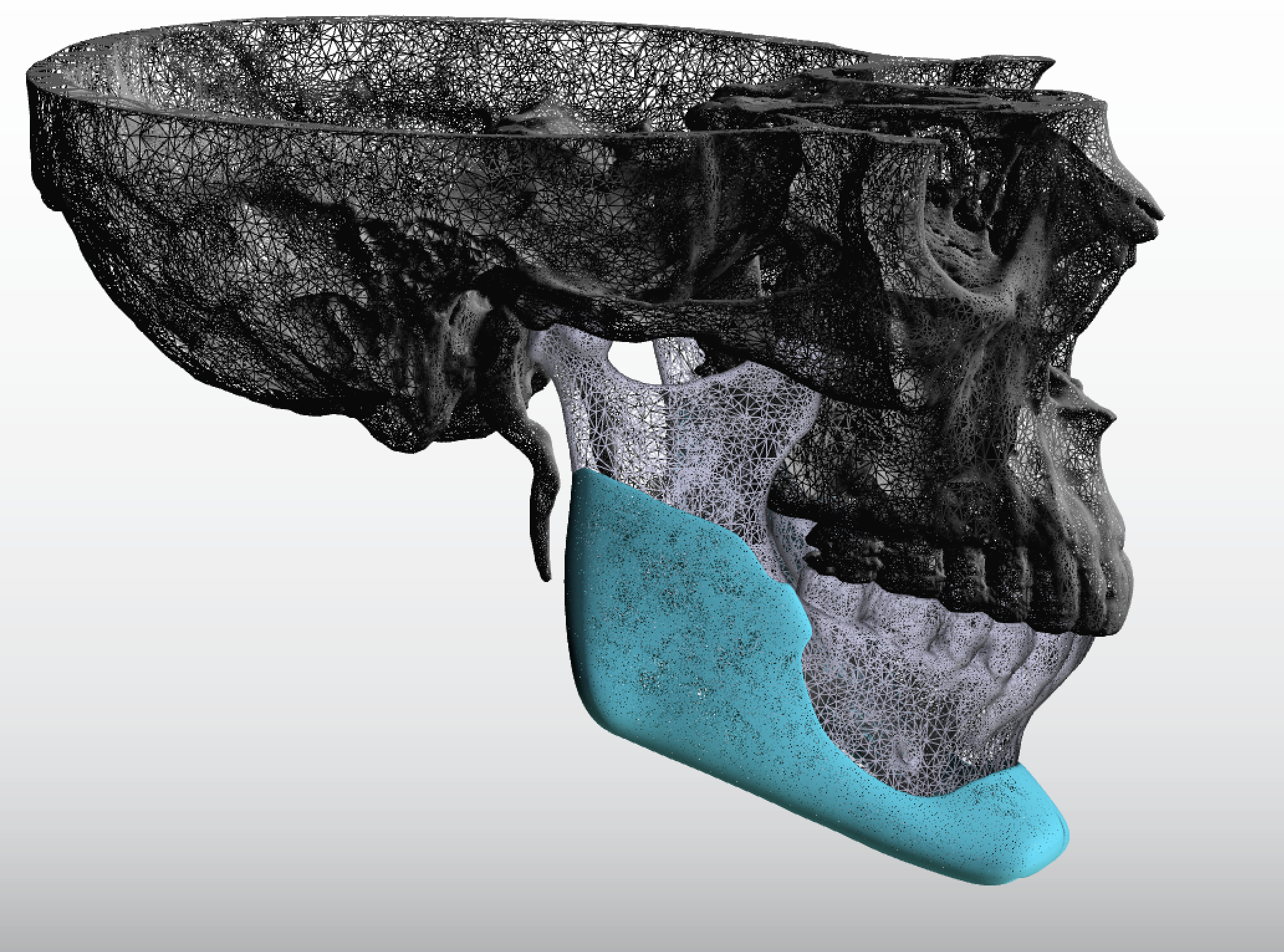Custom Jawline Implant with Vertical Jaw Angle Lengthening 3D design ...