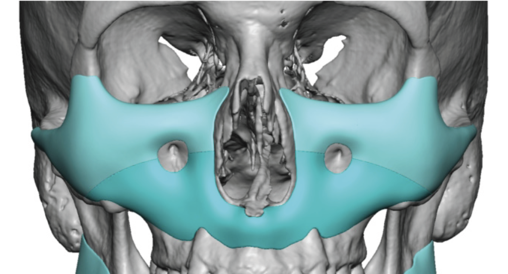 Technical Strategies - Buccal Fat Flap Coverage of the Custom Midface ...