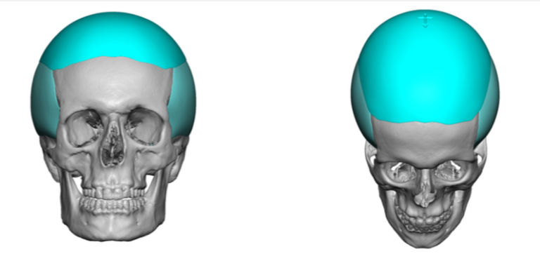 Plastic Surgery Case Study - Combining Custom Skull and Temporal ...