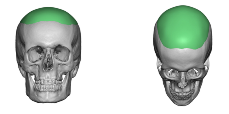 Plastic Surgery Case Study - Combining Custom Skull and Temporal ...