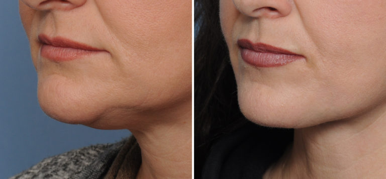 Female submental chin reduction result left oblique Dr Barry Eppley ...