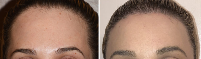Plastic Surgery Case Study - Total Soft Tissue Forehead Reshaping with ...