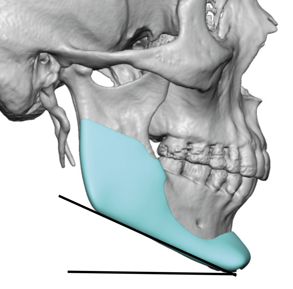 The Use Of Mandibular Plane and Gonial Angle Measurements in Custom ...