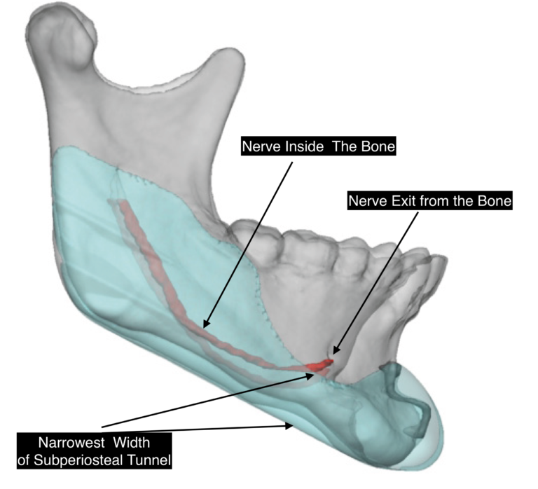 Technical Strategies - Surgical Placement of Solid Silicone Custom ...