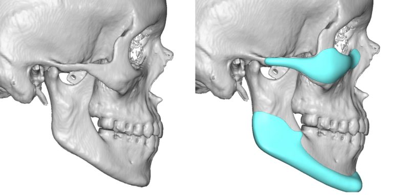 Plastic Surgery Case Study - Masculinizing the Soft Male Face with ...