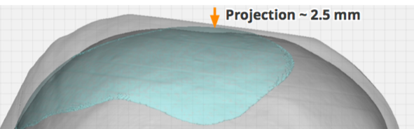 Male Custom Skull Implant design side view Dr Barry Eppley Indianaplis ...