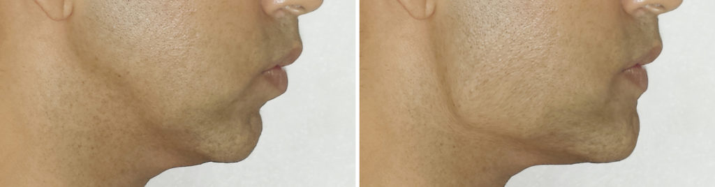 Plastic Surgery Case Study - Custom Jawline Implant Design for the High ...