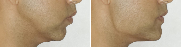 Plastic Surgery Case Study - Custom Jawline Implant Design for the High ...