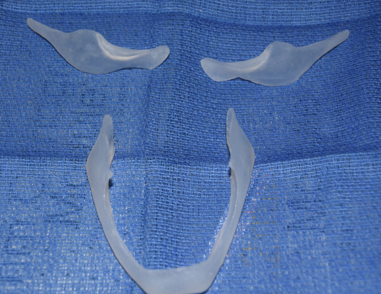 Male Maxculinization Custom Facial Implants intraop Dr Barry Eppley ...