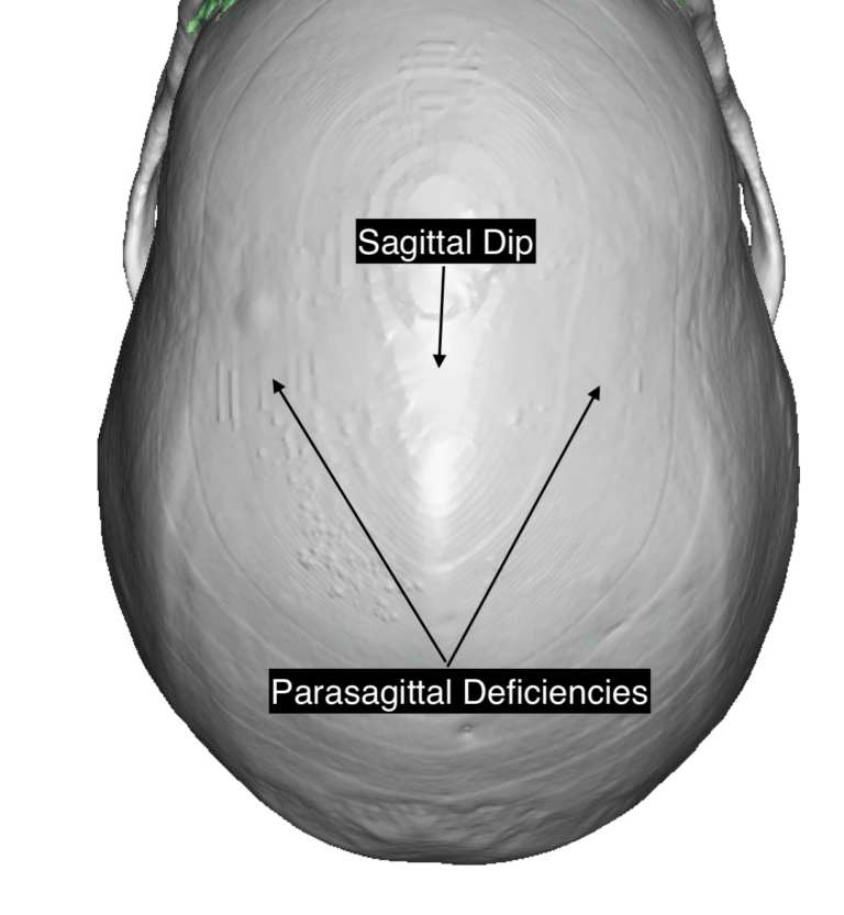 Plastic Surgery Case Study - The Use Of A Custom Skull Implant To ...