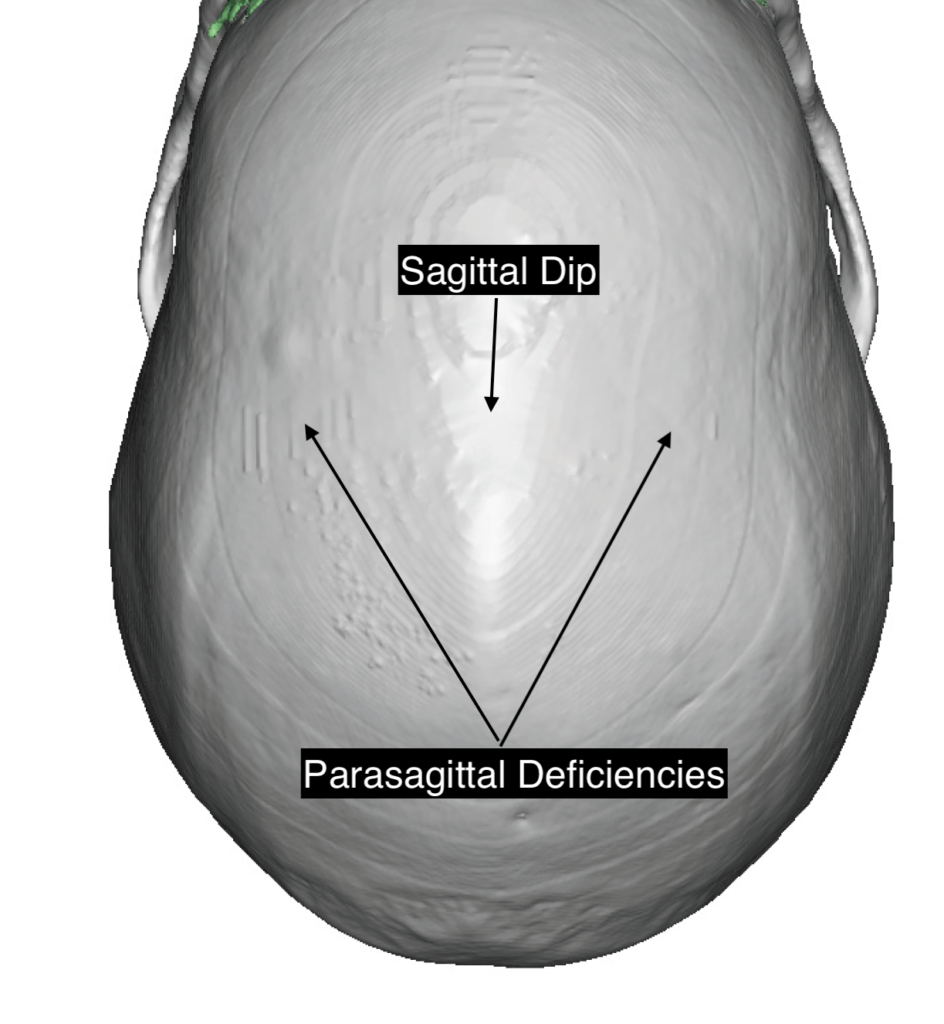 Plastic Surgery Case Study - The Use Of A Custom Skull Implant To ...