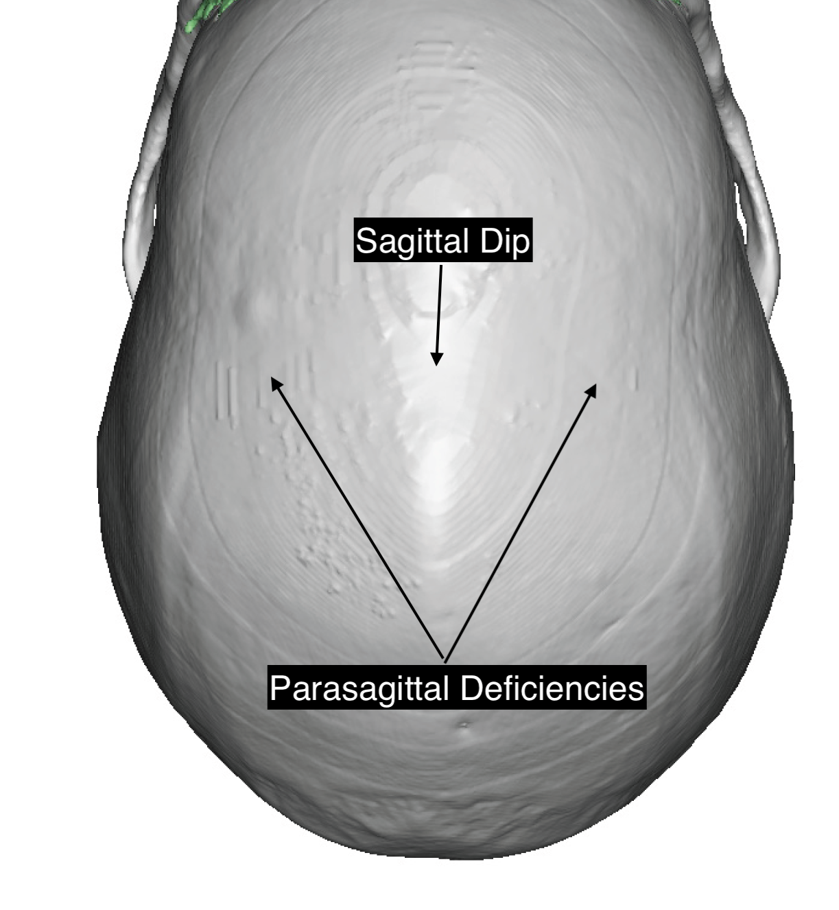 Plastic Surgery Case Study - The Use Of A Custom Skull Implant To ...