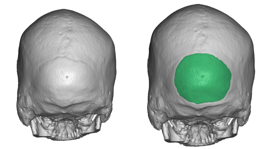 Plastic Surgery Case Study - Skull Asymmetry Correction with Occipital ...