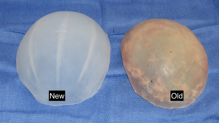 Plastic Surgery Case Study - Combining Custom Skull and Temporal ...