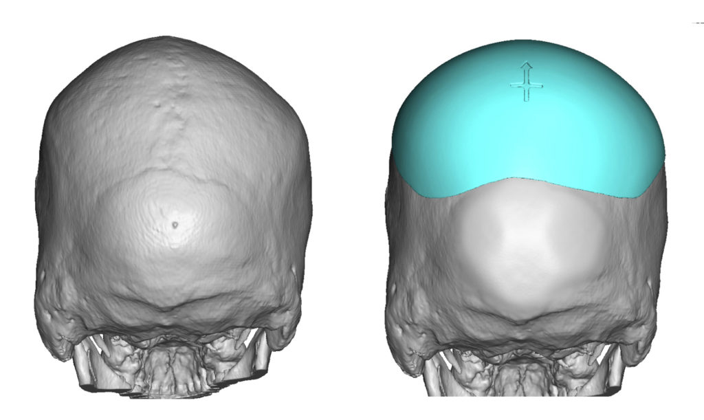 Plastic Surgery Case Study - Skull Asymmetry Correction with Occipital ...