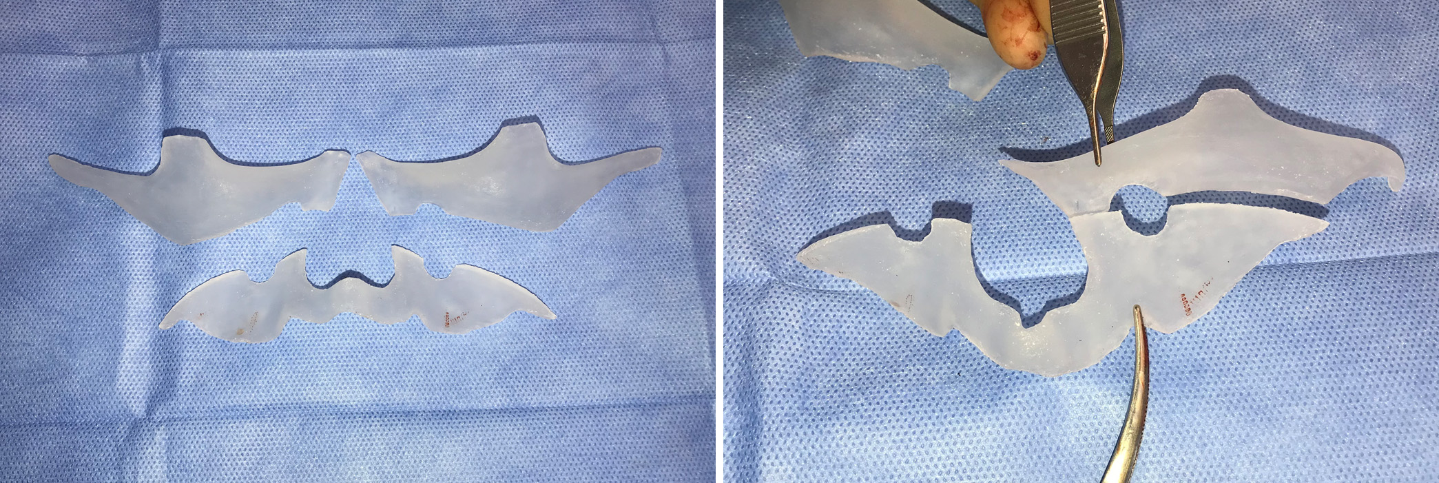 Three Piece Custom MIdface Mask Implant intraop Dr Barry Eppley ...