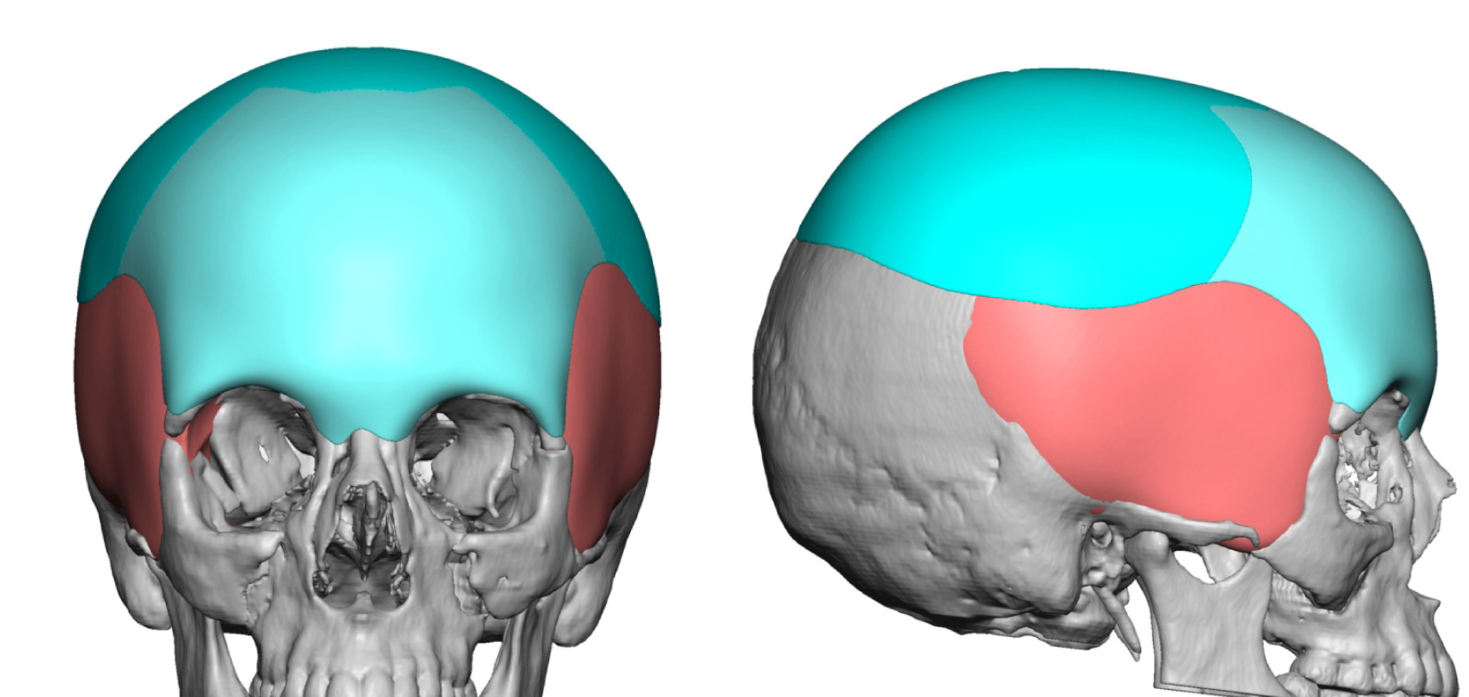Tweo Piece Large Custom Skull Implant design Dr Barry Eppley ...