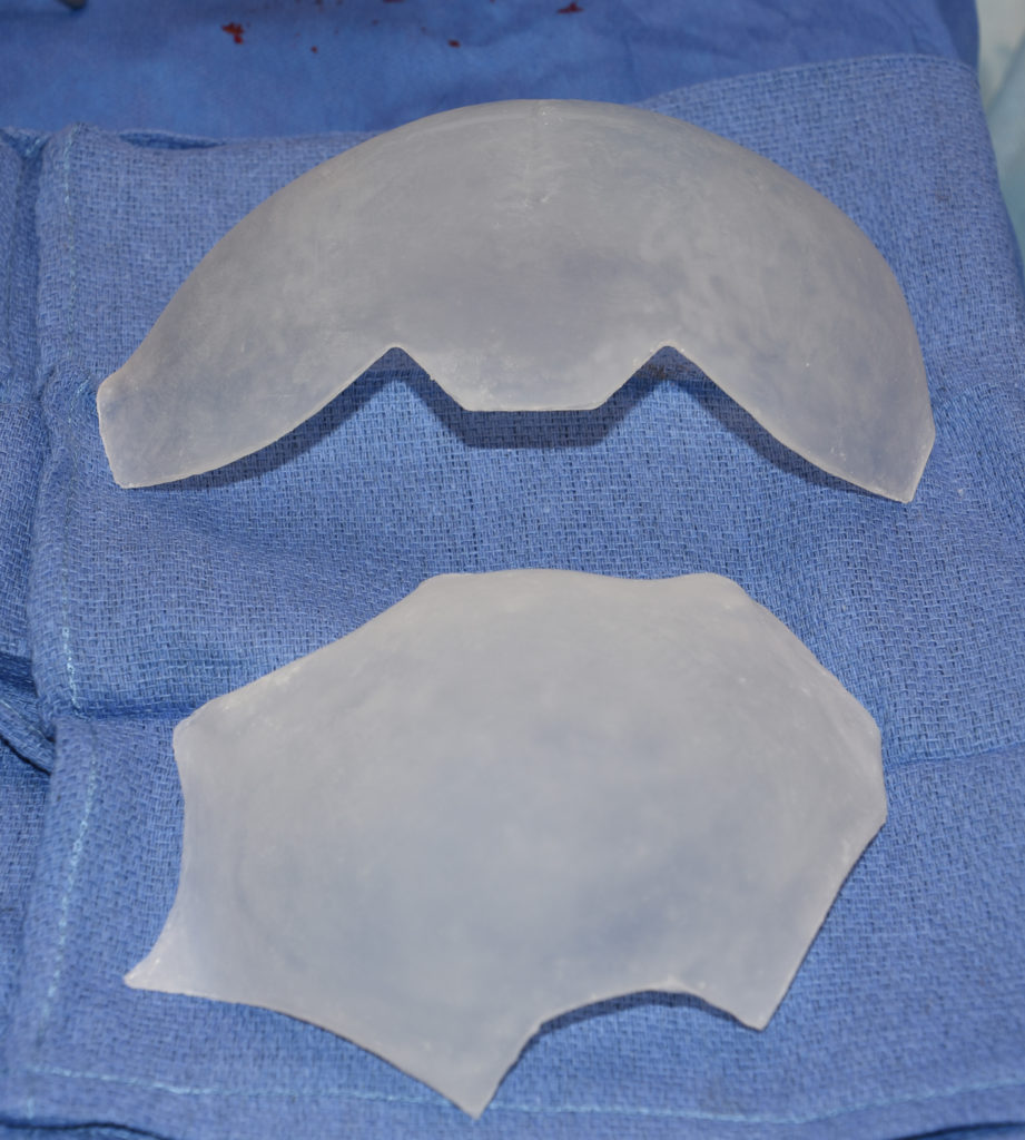 Plastic Surgery Case Study - Large Two-Piece Custom Skull Implant ...