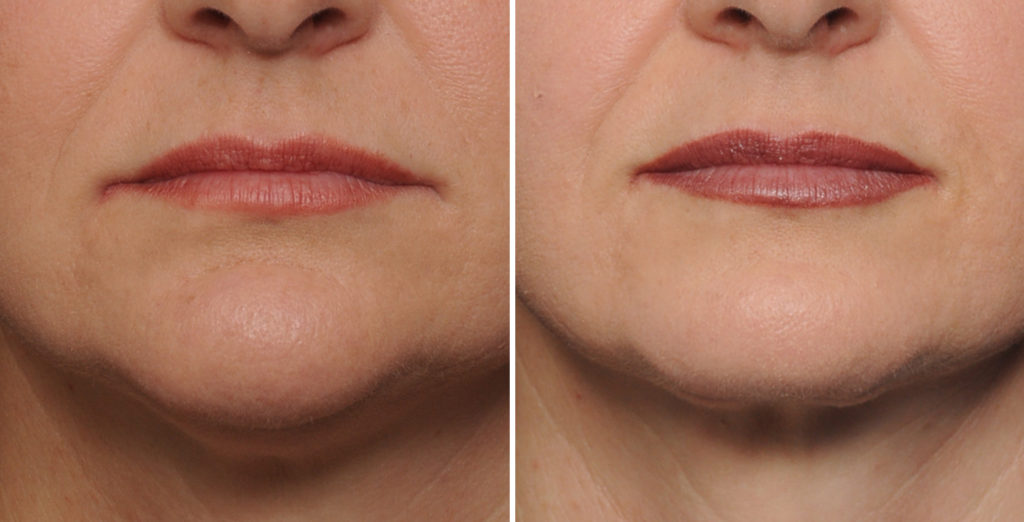 Plastic Surgery Case Study - Submental Chin Reduction for the Ball ...