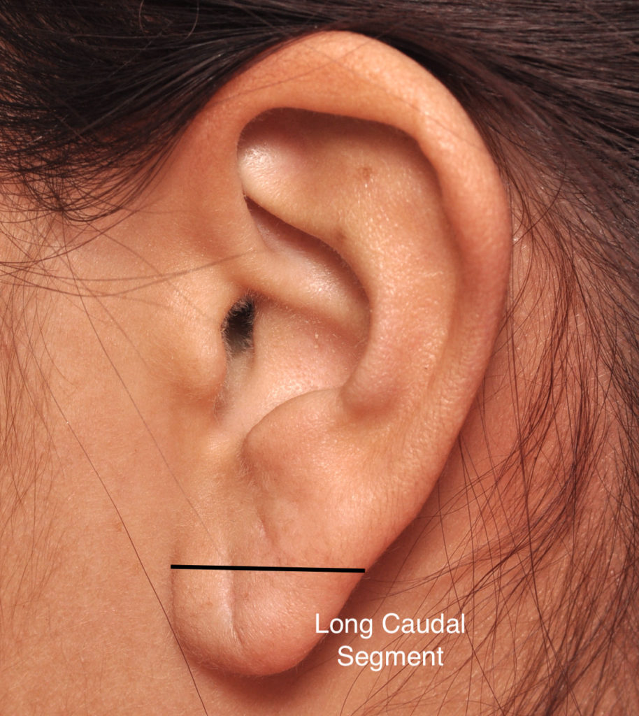 Plastic Surgery Case Study - Earlobe Reduction of Caudal Ptosis in ...