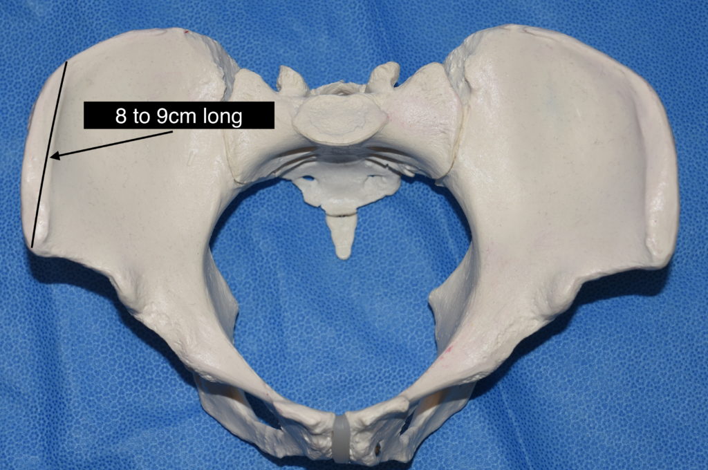 Iliac Crest Bone Reduction Superior View Dr Barry Eppley Indianapolis Explore Plastic Surgery