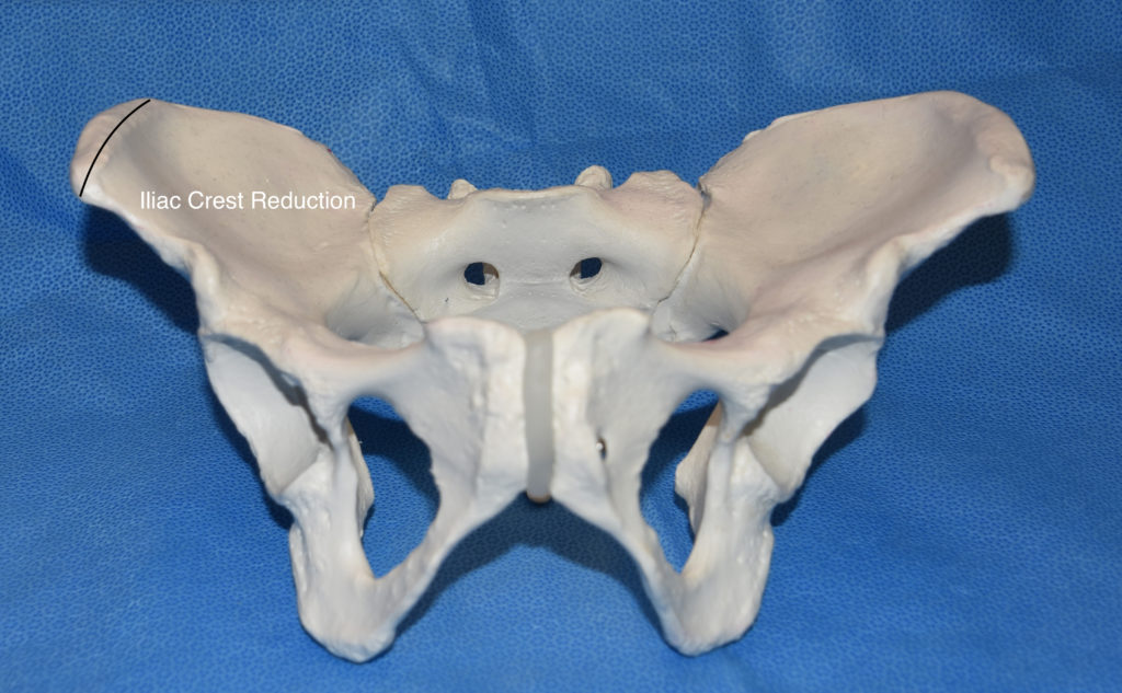 iliac crest reduction front view Dr Barry Eppley Indianapolis - Explore ...