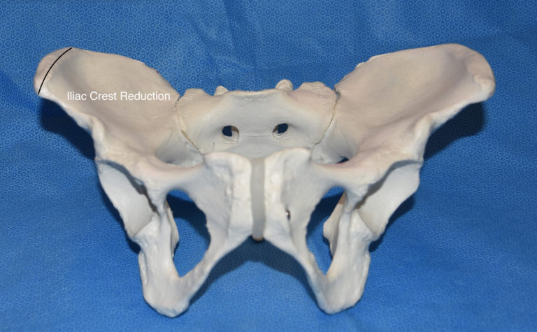 The Anatomy Basis of Aesthetic Iliac Crest Reduction - Explore Plastic ...