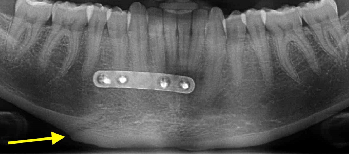 Plastic Surgery Case Study - Smiley Plate Fixation of the Inverted T ...