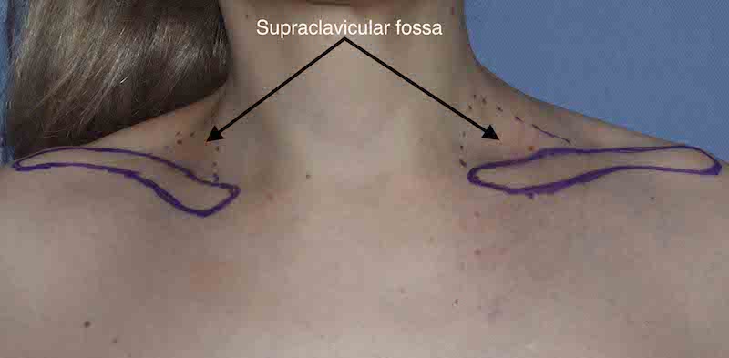 Clavicle Marking for Shoulder reduction preop Dr Barry Eppley ...