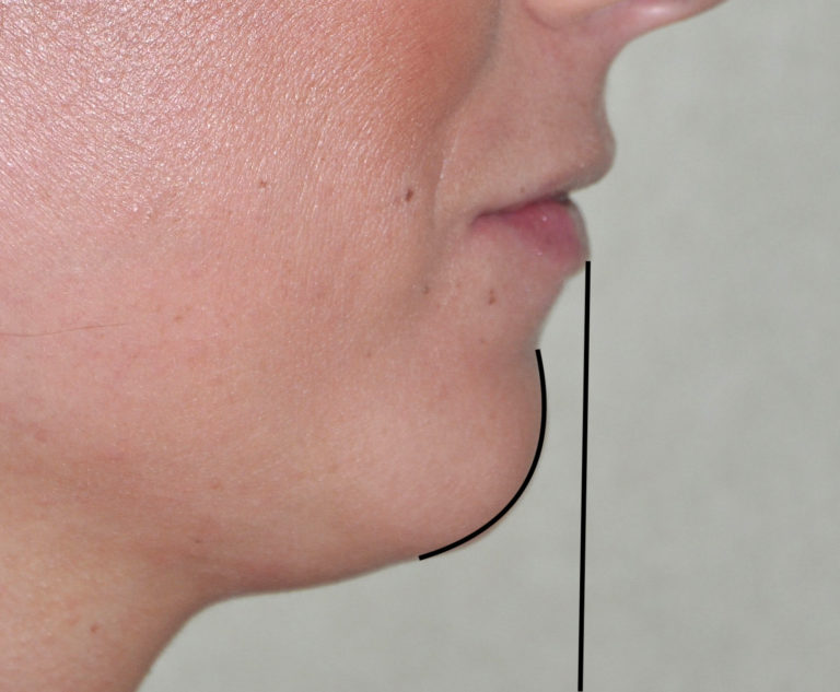 The Two Step Process in Chin Implant Selection Step 1 - Chin Shape ...
