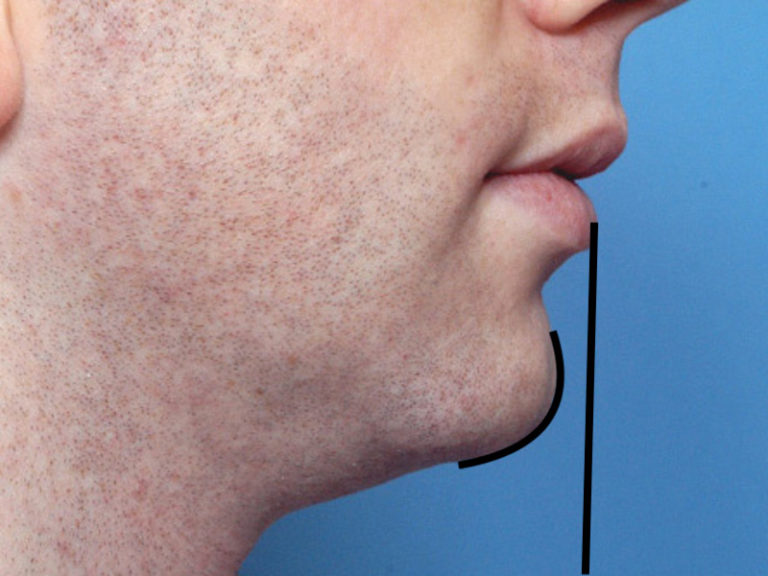 The Two Step Process in Chin Implant Selection Step 1 - Chin Shape ...