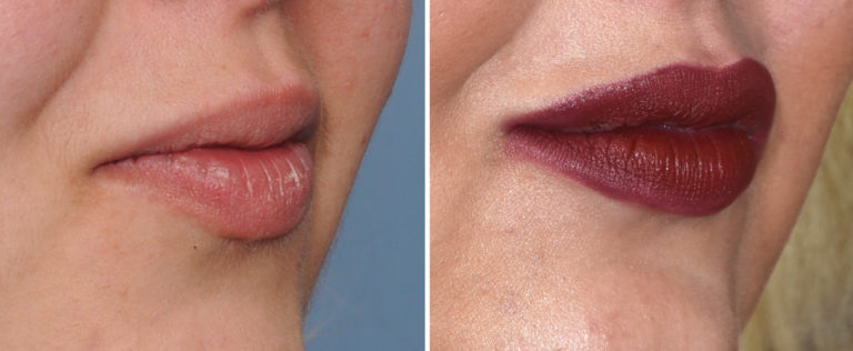 Plastic Surgery Case Study - Corner of Mouth Lifts Combined With Lip ...