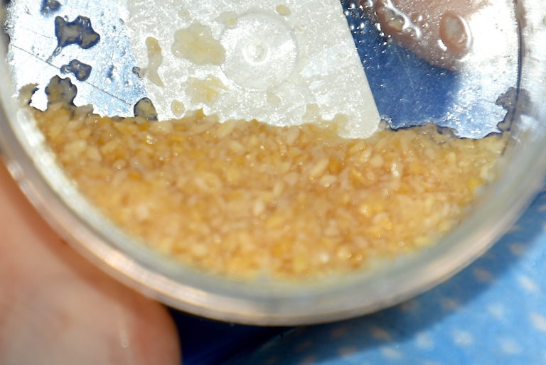 Plastic Surgery Case Study - Corticocancellous Chip Grafting of the ...