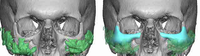3D CT Scan Assessment of The Effects of Injectable Fillers vs Cheek ...